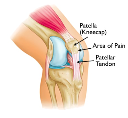 OSGOOD-SCHLATTER DISEASE VS SINDING-LARSEN-JOHANSSON SYNDROME - Pakenham Osteopathy