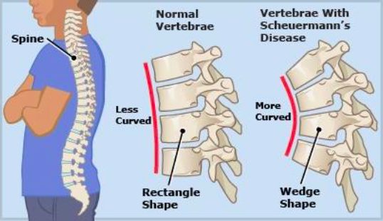 UNDERSANDING SCHEUERMANN'S DISEASE - Pakenham Osteopathy