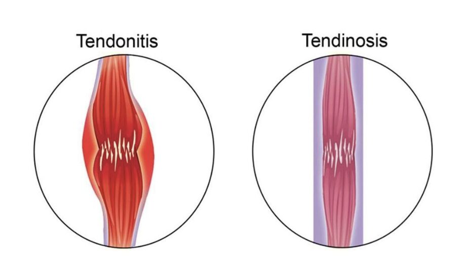 UNDERSTANDING THE DIFFERENCE: Tendinopathy, Tendinitis, and Tendinosis ...